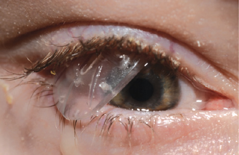 Late-Onset Plate Migration and Herniation of a Glaucoma Drainage Device ...