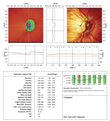 The Role of Optic Nerve Head Imaging - Glaucoma Today