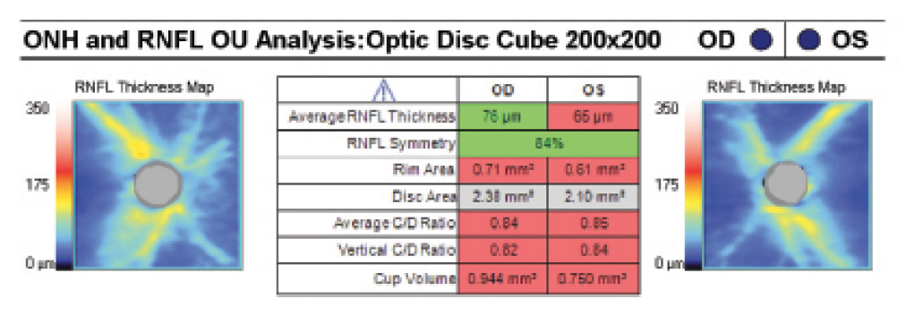 The Role of Optic Nerve Head Imaging - Glaucoma Today