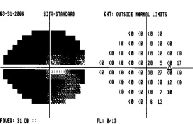 Enhancing Visual Field Testing Glaucoma Today