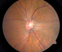 Detecting and Treating Glaucoma in a Myopic Patient Without High IOP ...