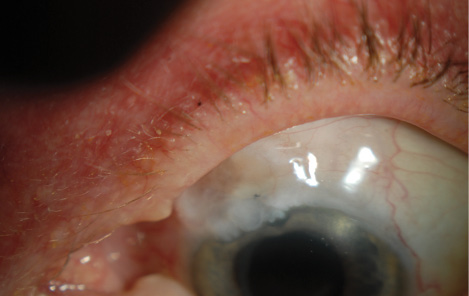 Managing a Failed Trabeculectomy - Glaucoma Today