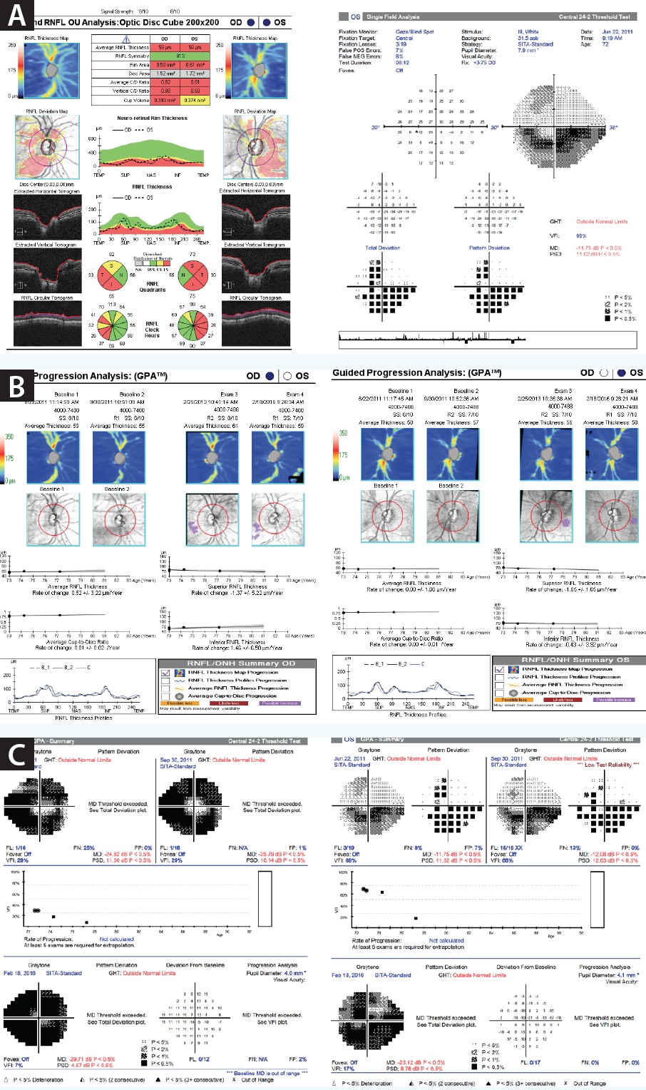 Do We Need Perimetry? - Glaucoma Today
