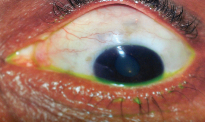 Highlights of the 2016 ARVO Annual Meeting - Glaucoma Today