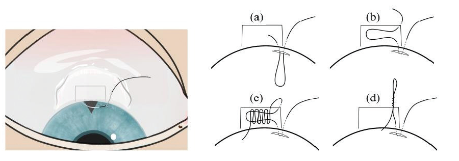 Tips and Tricks - Glaucoma Today