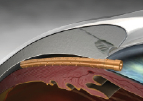 Suprachoroidal Access: the Next Big Thing? - Glaucoma Today