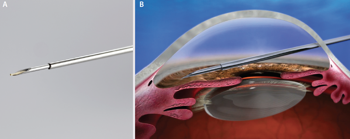 Making Subconjunctival Filtration Surgery Great Again? - Glaucoma Today