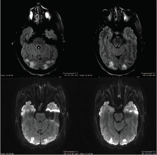 Posterior Reversible Encephalopathy Syndrome Pres Pediatric Posterior