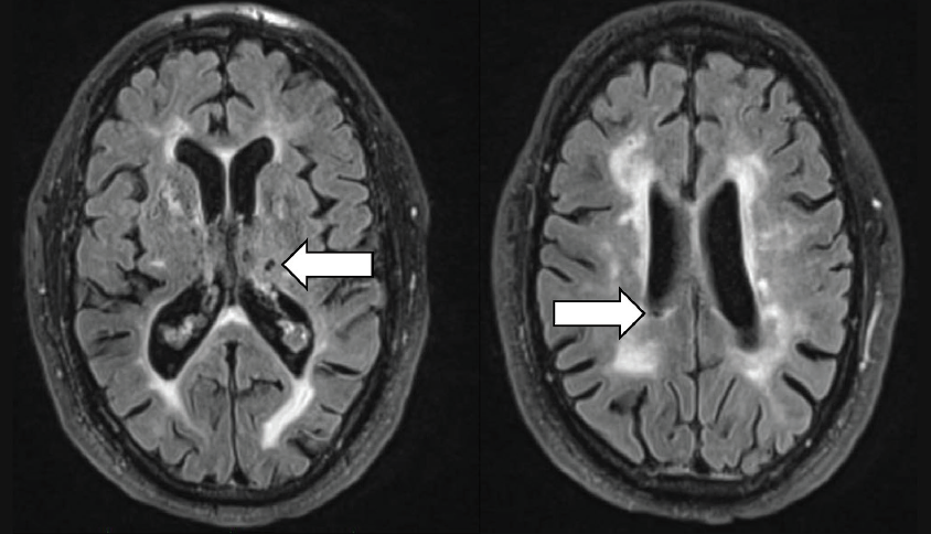 Vascular Cognitive Impairment - Practical Neurology