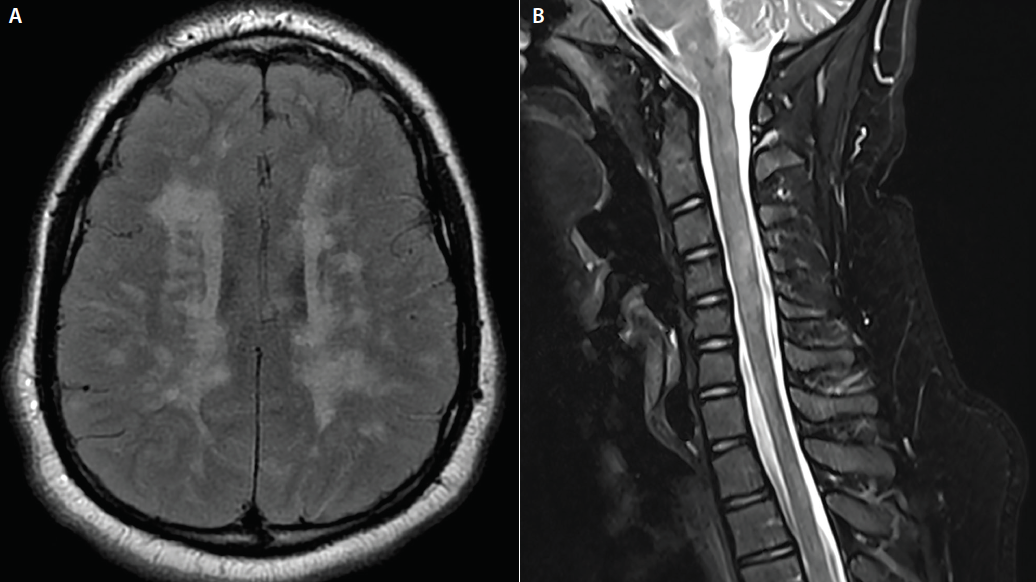 Pediatric-Onset Multiple Sclerosis - Practical Neurology