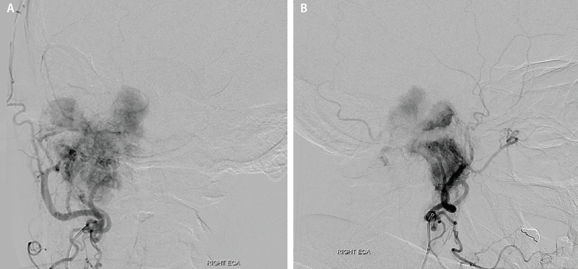 Case Report: A Woman with Tinnitus and Tongue Atrophy - Practical Neurology