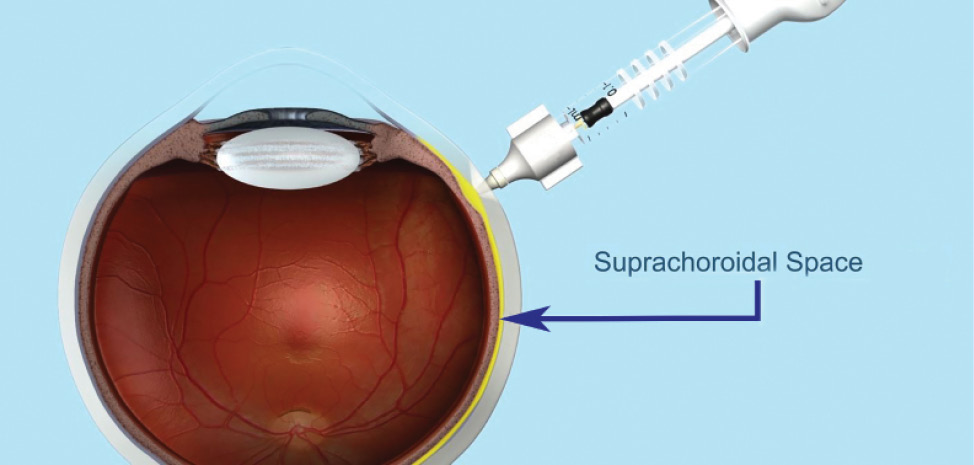Suprachoroidal Administration: A Targeted Approach to Treating Retinal ...