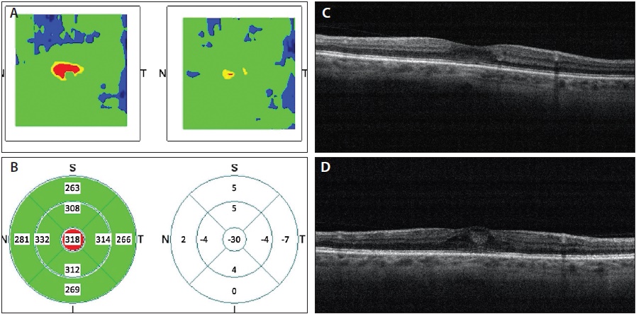 Micropulse Laser Therapy: Not The Emperor's New Clothes - Retina Today