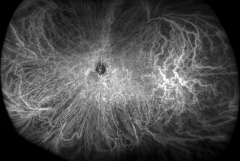 10 Reasons to Image the Peripheral Retina - Retina Today