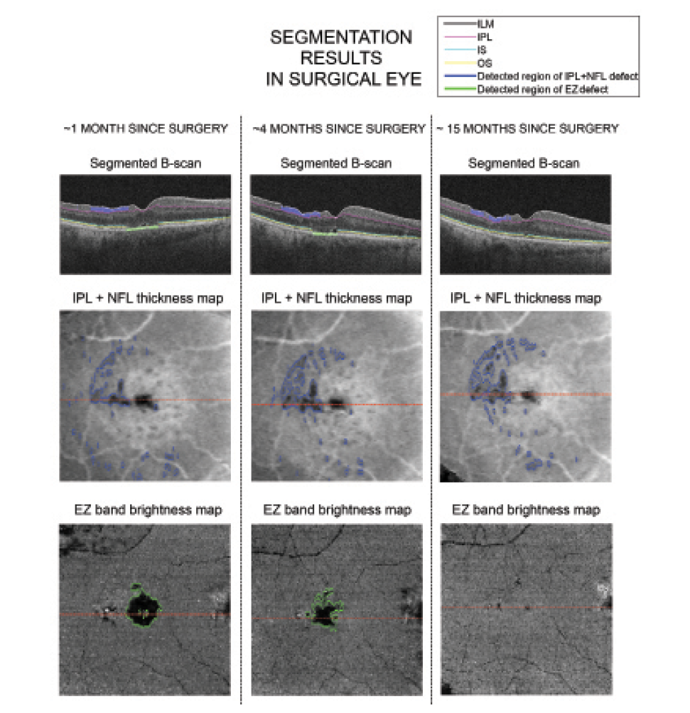Fully Automated OCT Analysis of Eyes Healing From Macular Hole Surgery ...