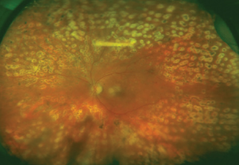 Imaging Modalities for the Management of DME - Retina Today