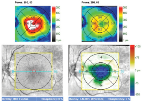 Imaging Modalities for the Management of DME - Retina Today