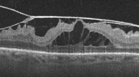 Imaging Modalities for the Management of DME - Retina Today