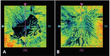 Use of En Face OCT to Identify Elevated ERM - Retina Today