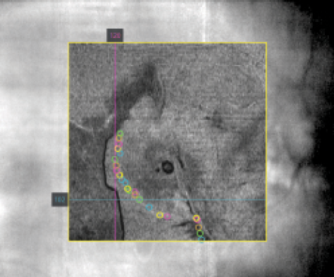 Use of En Face OCT to Identify Elevated ERM - Retina Today