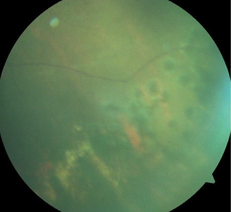 Retinal Redetachment After Silicone Oil Removal - Retina Today