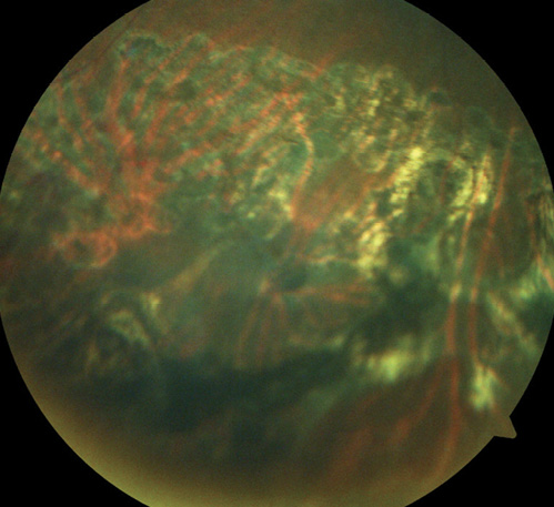 Retinal Redetachment After Silicone Oil Removal - Retina Today