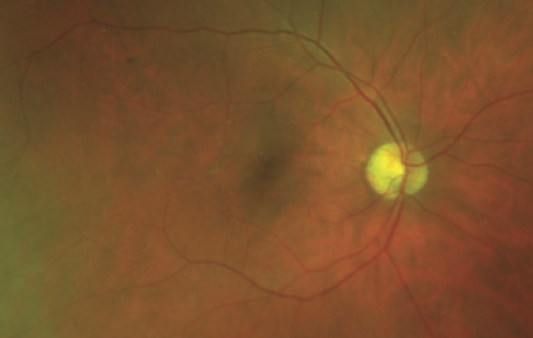 Evaluating Changes in Diabetic Retinopathy - Retina Today