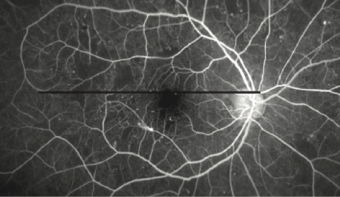 Evaluating Changes in Diabetic Retinopathy - Retina Today