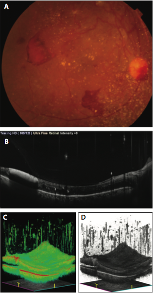 Imaging the Vitreous and Vitreomacular Interface - Retina Today