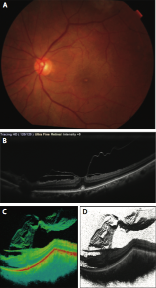 Imaging the Vitreous and Vitreomacular Interface - Retina Today