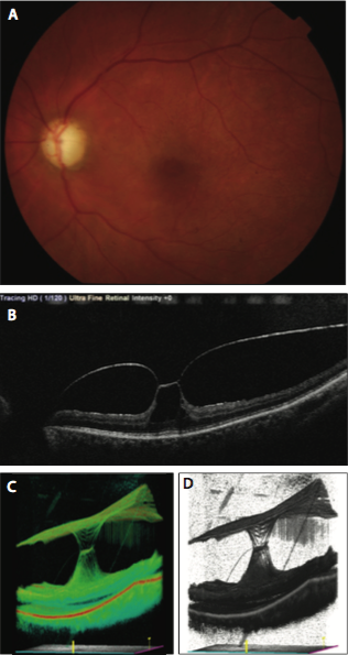 Imaging the Vitreous and Vitreomacular Interface - Retina Today