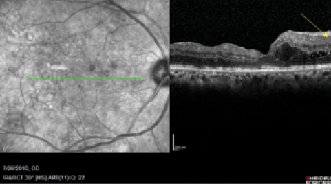 Get the Most Out of Your SD-OCT Device - Retina Today