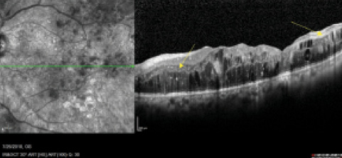 Get the Most Out of Your SD-OCT Device - Retina Today