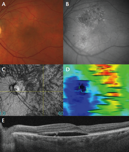 The Pachychoroid Clinical Spectrum - Retina Today