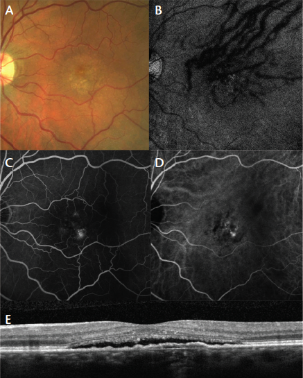 The Pachychoroid Clinical Spectrum - Retina Today
