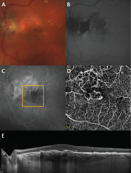 The Pachychoroid Clinical Spectrum - Retina Today