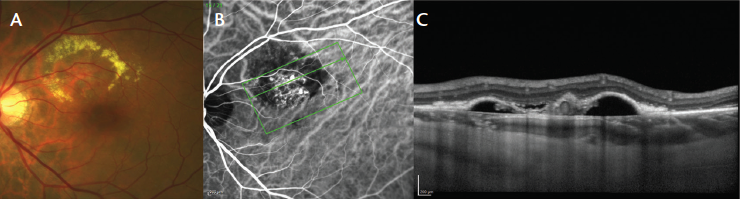 The Pachychoroid Clinical Spectrum - Retina Today