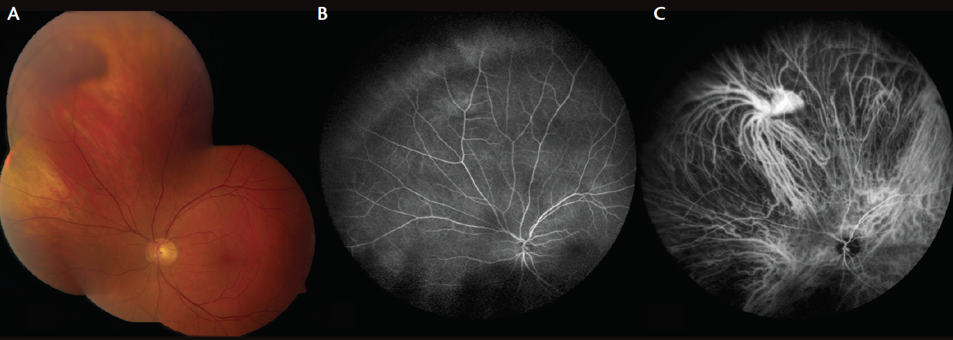 ICGA of Vortex Vein Varix Simulating Choroidal Melanoma - Retina Today