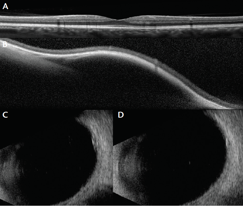 ICGA of Vortex Vein Varix Simulating Choroidal Melanoma - Retina Today