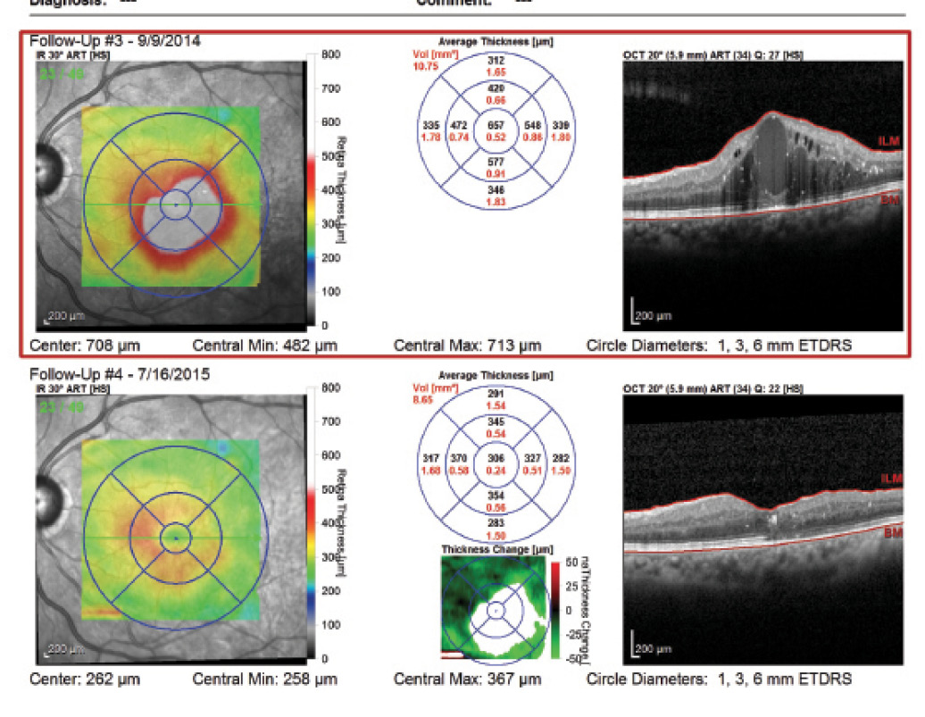 Vitrectomy With ILM Removal for DME Resistant to Conventional Treatment ...