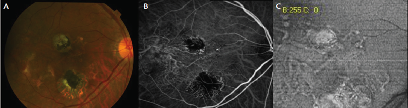 Polypoidal Choroidal Vasculopathy - Retina Today