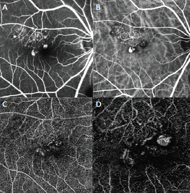 Polypoidal Choroidal Vasculopathy - Retina Today