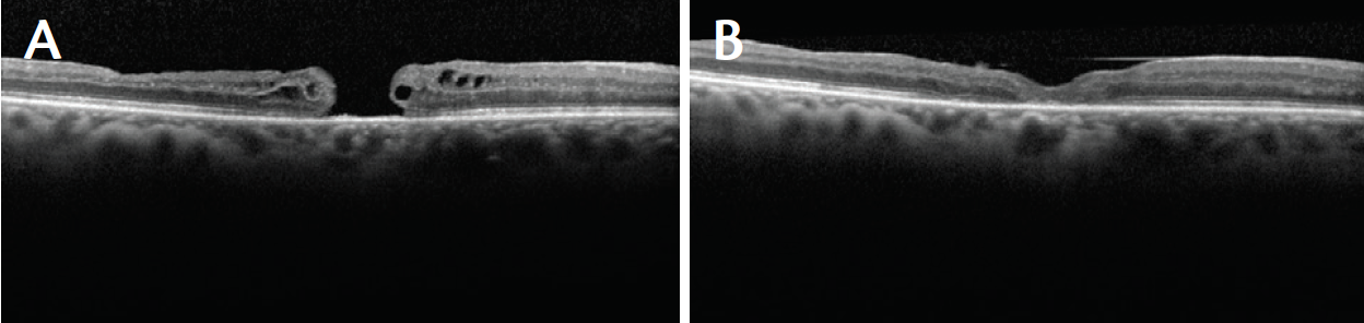 Macular Hole Repair Using an ILM Patch - Retina Today