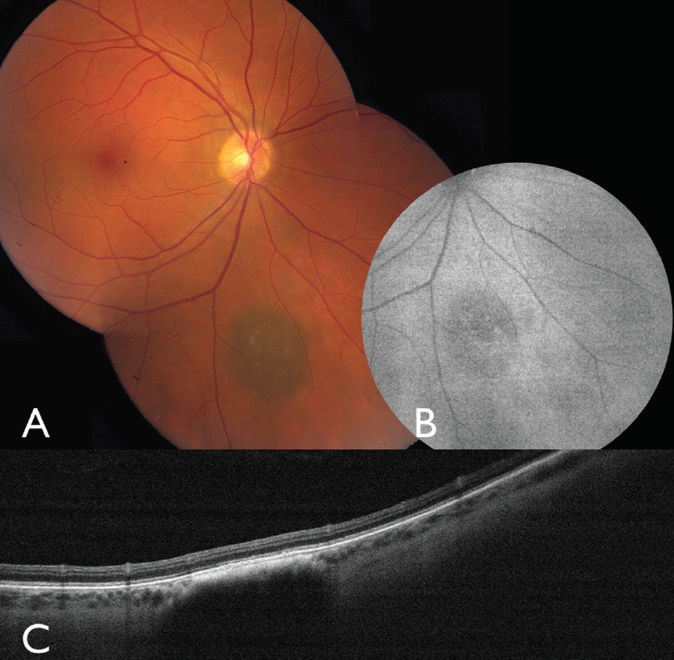 Which Tumor, What Imaging Modality? - Retina Today