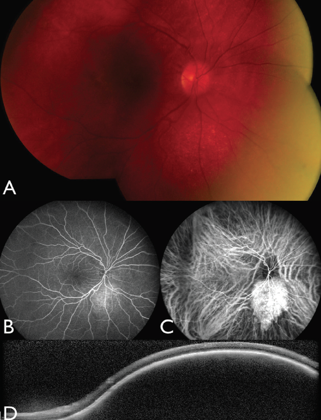 Which Tumor, What Imaging Modality? - Retina Today