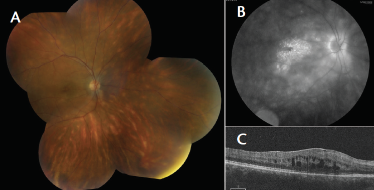 The Burden of Noninfectious Uveitis of the Posterior Segment: A Review ...