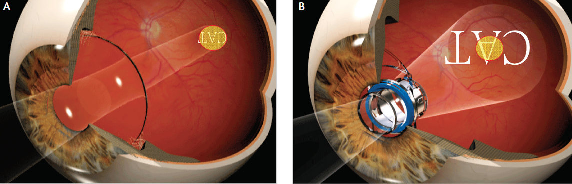 A Team-Based Approach to Treating Advanced Macular Degeneration ...