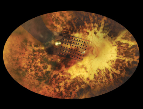 5-Year Results With a Retinal Prosthesis System - Retina Today