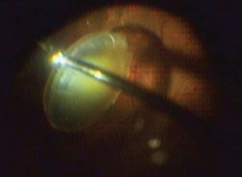 Versatile Vitrectomy - Retina Today