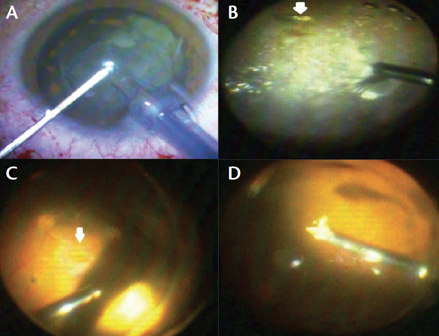 Versatile Vitrectomy - Retina Today